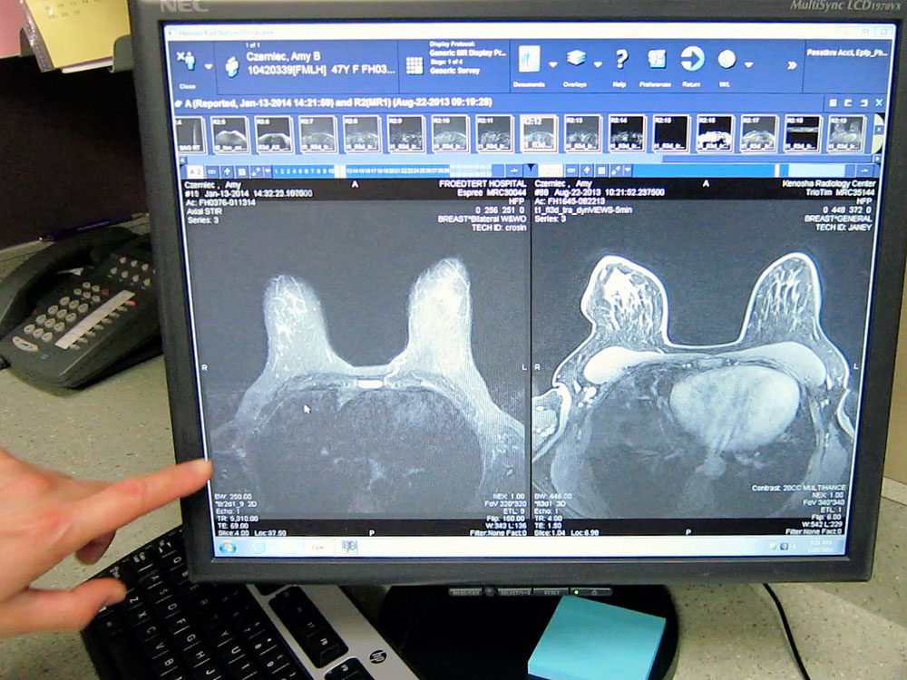 Breast cancer: Amy's blog & video journey — chemo, surgery, radiation